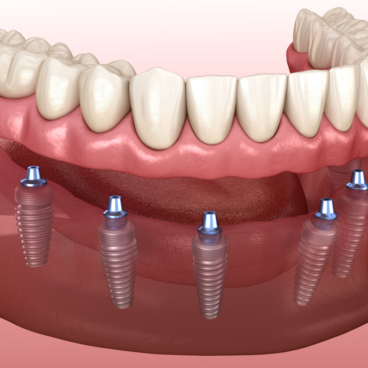Porcelain Dental Bridges | Houston, TX, Best Cosmetic Dentists Near You